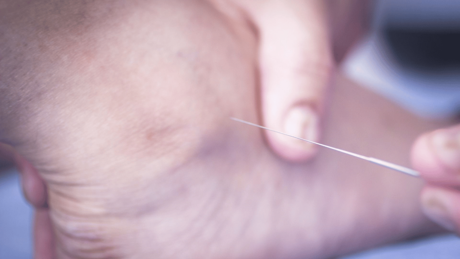 Dry Needling Singapore | Dry Needling Physiotherapy
